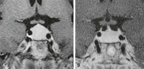 Disorders Of Prolactin Secretion And Prolactinomas Clinical Gate