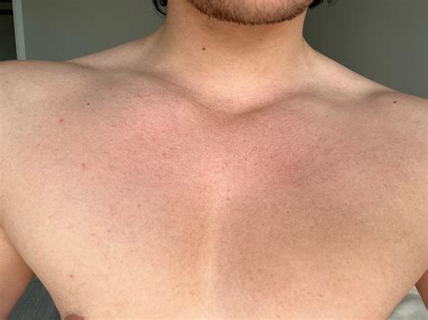 Red Chest R SkincareAddicts
