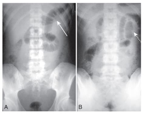 Sentinel Loop Appendicitis