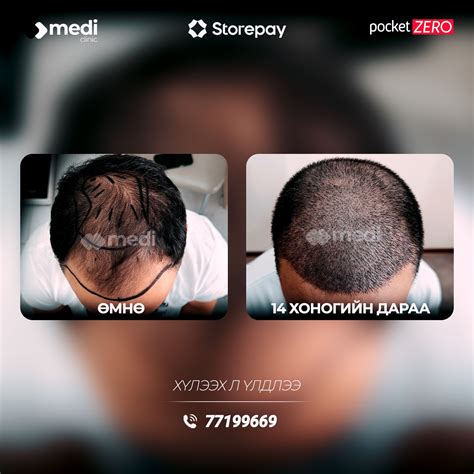 Medi Clinic 1 🟢Үс шилжүүлэн суулгах мэс ажилбараас 14 Facebook