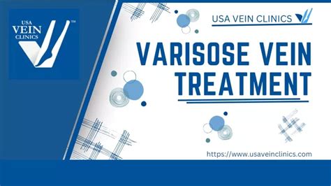 Ppt Varicose Vein Treatment Powerpoint Presentation Free Download