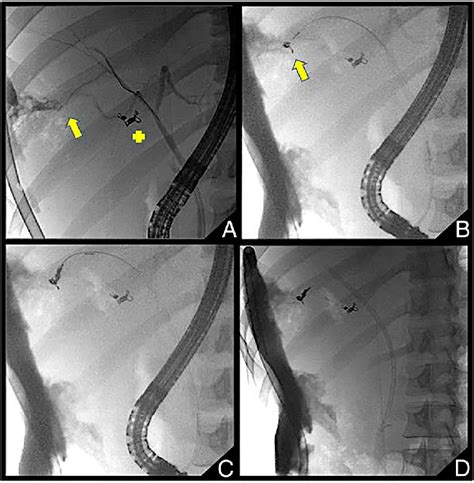 Sequential Cholangiograms A Bile Leak From The Right Intrahepatic Download Scientific