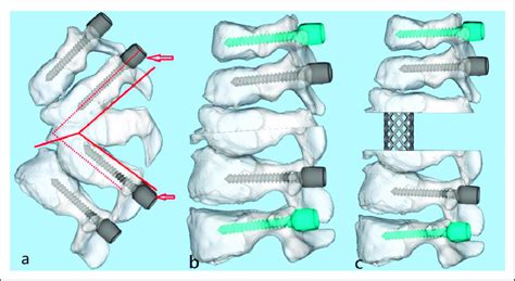 Schematic Diagram Of Closed Osteotomy A If A Simple Closed Osteotomy