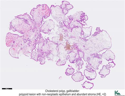 Pathology Outlines Cholesterol Polyp