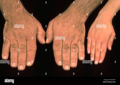 Acromegaly Diagnosis