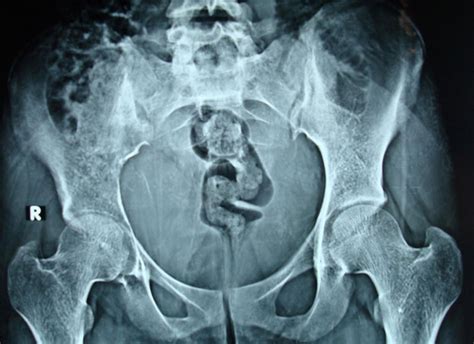 Digital X Ray Pelvis Ap View Showing Reduced Right Hip Joint Space With Download Scientific