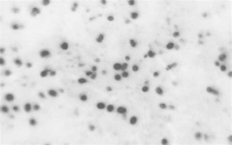 Rethinking Antibiotic Use In Pediatric Pink Eye Cases Obn