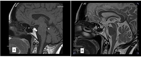 Mri Of The Pituitary Gland Sagittal Section Arrowhead Indicates