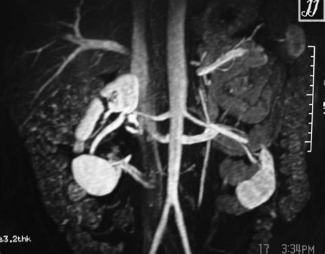Abdomen Abdominal Mra Radiopaedia