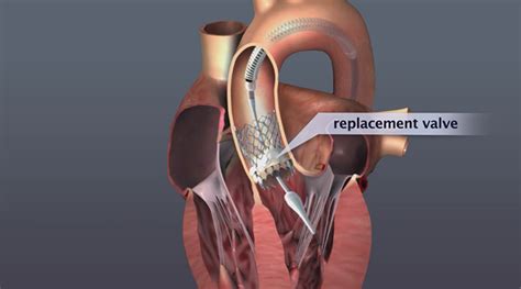 Transcatheter Aortic Valve Replacement Tavr Procedure Northshore