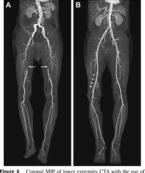 Figure 3 From Optimization Of The Table Speed Of Lower Extremity Ct Angiography Protocols In
