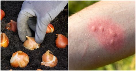 Itchy Bumps On Hands After Gardening At Janet Wall Blog