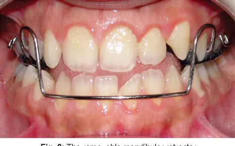 Figure 3 From Mandibular Retractor Vs The Bone Anchored Intermaxillary