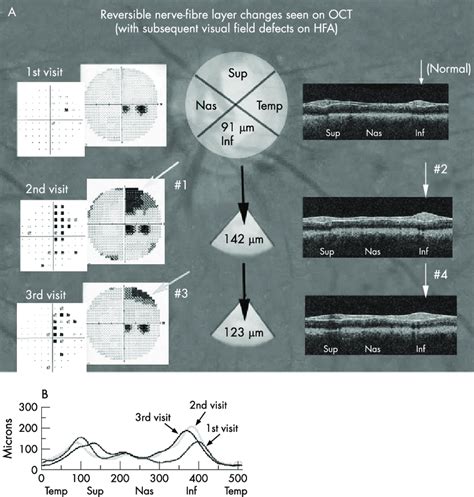 A There Is A New Onset Superior Temporal Visual Field VF Defect On