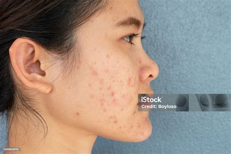 그녀의 뺨에 여드름 염증 의 문제가있는 여성의 반 얼굴의 측면보기 여드름에 대한 스톡 사진 및 기타 이미지 여드름 뾰루지 흉터 Istock