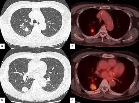 Chest Computed Tomography Scans Showed A An Irregular Nodular Download Scientific Diagram