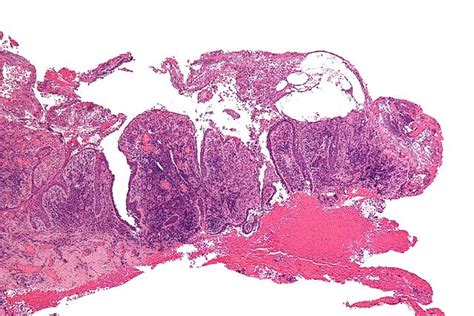 Pemphigus Vulgaris — Pathology Outlines And Treatment Medical Library