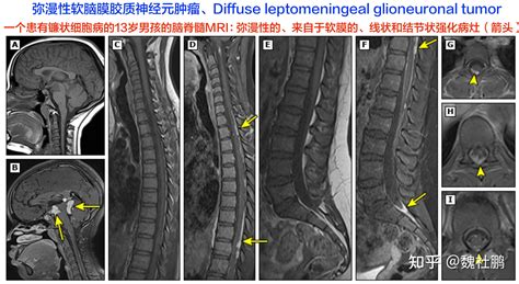 弥漫性软脑膜胶质神经元肿瘤 知乎