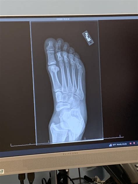 Broken Fibula And Partially Dislocated Tibia Rbrokenbones