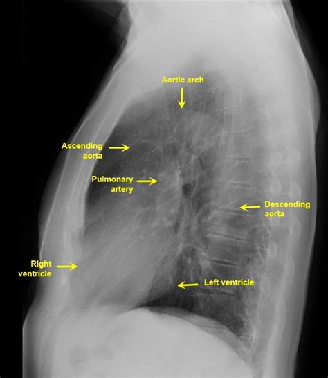 Normal Chest X Ray Markings At Norman Ellis Blog