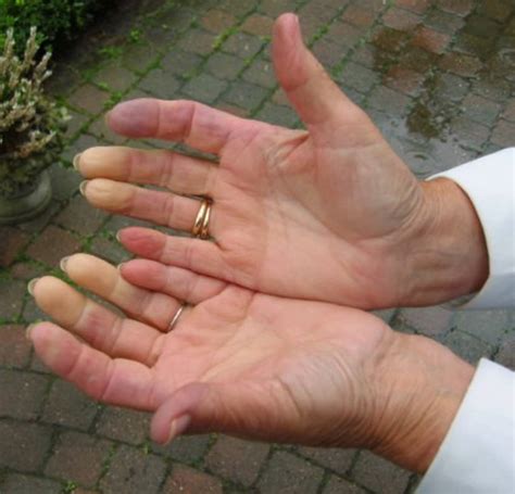 Skleroderma Gejala Penyebab Pengobatan Dll • Hello Sehat