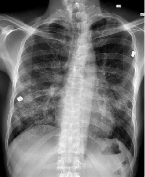 Pjp Pneumonia — Inside The Silver Fridge