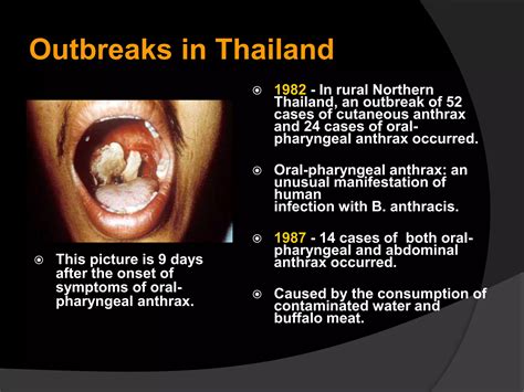 Anthrax Pptx