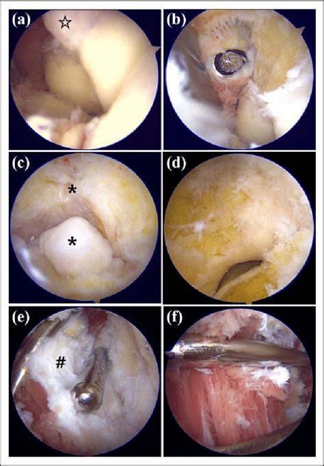Arthroscopic Osteocapsular Arthroplasty A And B Clearance In The