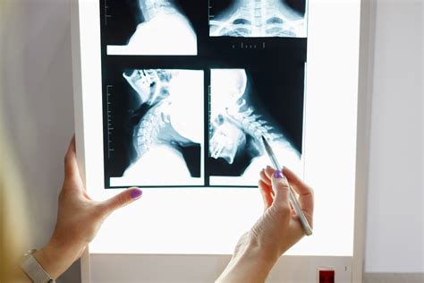 Lumbar Disc Replacement Vs Spinal Fusion Advanced Disc Replacement