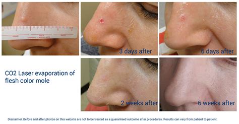Epidermal Nevus Removal