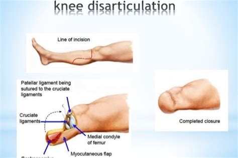 Fundraiser By Jon Jones Jon Joness Elective Amputation