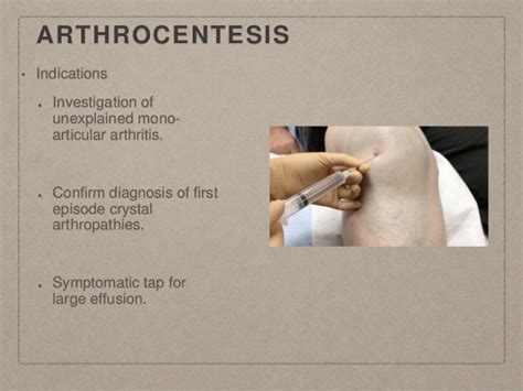 Arthrocentesis