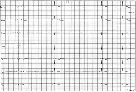 One Of The Most Important Diagnostic Tests In Cardiology To Interpret Is The Ekg Here Are My