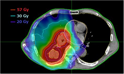 Representative Actual Treatment Plan Of Intensity Modulated Download Scientific Diagram