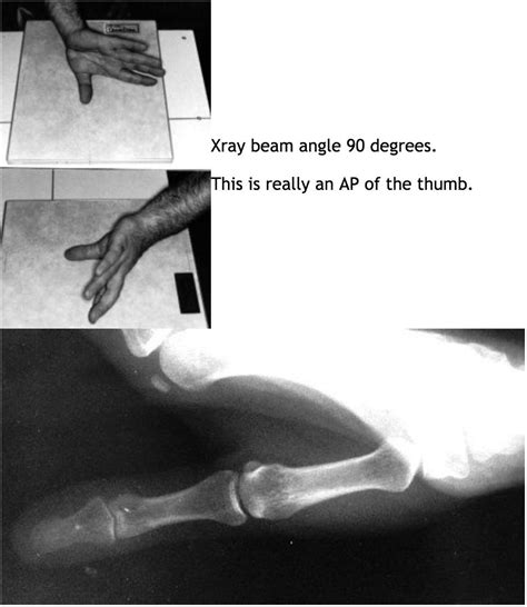 Metacarpal Fractures Hand Orthobullets