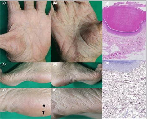 Image Gallery Unilaterally Dominant Acrokeratoelastoidosis Punctate