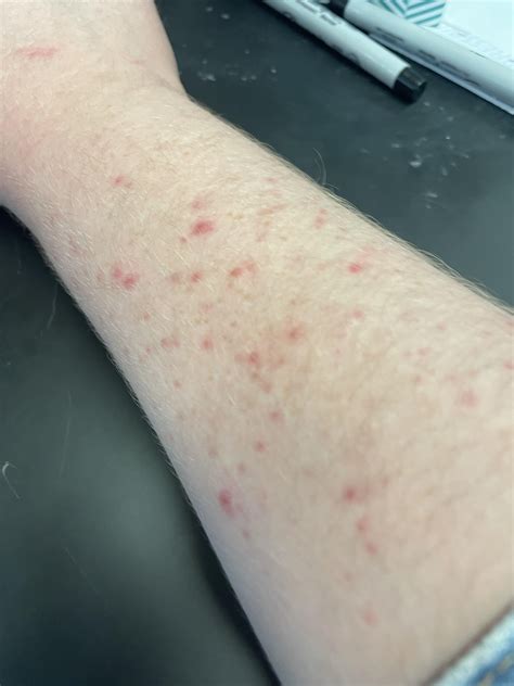 Tiny Red Bumps On Arms Rdermatology