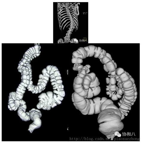 Ct三维重建综述vtk Cpr拉直 Csdn博客