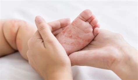 Сыпь у ребенка виды причины появления температура лечение отзывы врачей