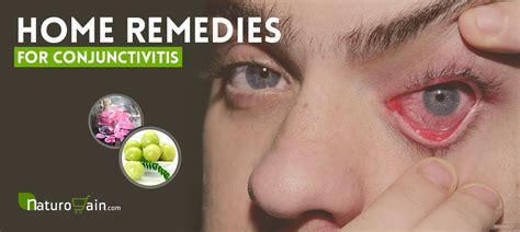 9 Best Home Remedies For Conjunctivitis To Prevent Pink Eyes Naturally