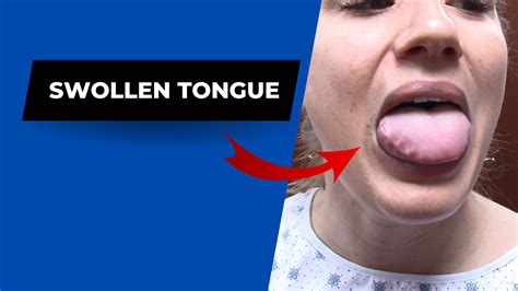 How To Know If You Have An Enlarged Tongue At Susan Arana Blog