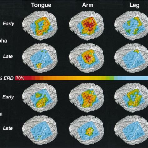 Maps Of Ecog Spectral Analysis And Cortical Stimulation Results In Download Scientific Diagram