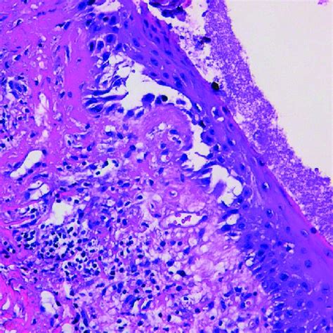 Polymorphous Eruption Papules And Erythematous Macules Vesicles
