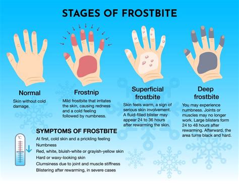Cold Realities How Science And Speed Save Lives In Frostbite