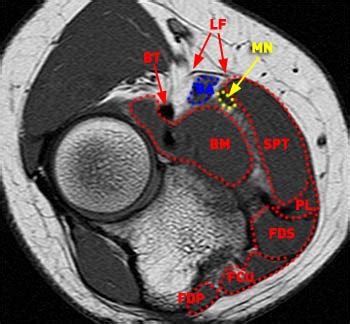 Median Nerve Entrapment Radsource