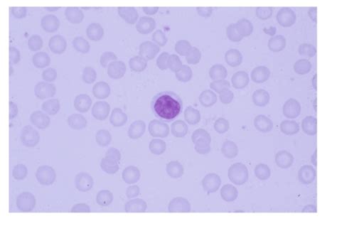 Hyperproliferative Disorders Flashcards Quizlet