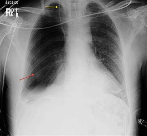 Pneumothorax Due To Cv Line Radiology At St Vincents University Hospital