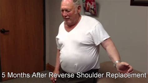 Reverse Total Shoulder Replacement Before After 55 Off