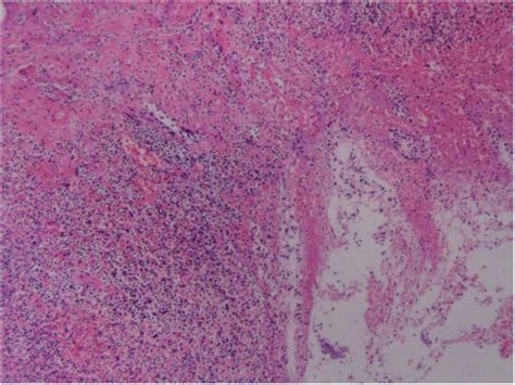 Postoperative Pathology Reveals Acute Gangrenous Appendicitis With Download Scientific Diagram