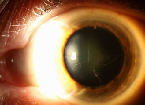 Atlas Entry Lattice Corneal Dystrophy